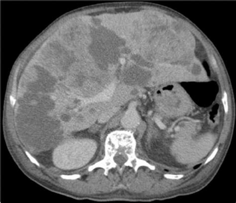 Multiple Hepatic Metastases Download Scientific Diagram