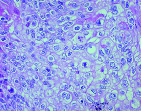 Areas Showing Squamous Differentiation He Stain 400x Download