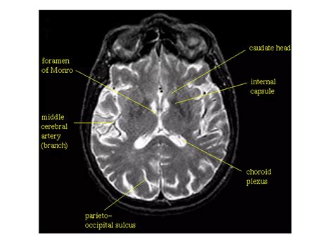 Diagnostic Imaging Of Hydrocephalus And Pneumocephalus Ppt Brain And