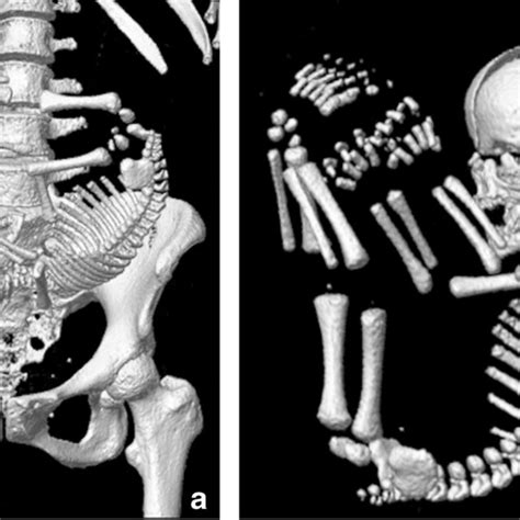 Fetal Ct Volume Rendered Reformatted Imaging In A 32 Week Fetus