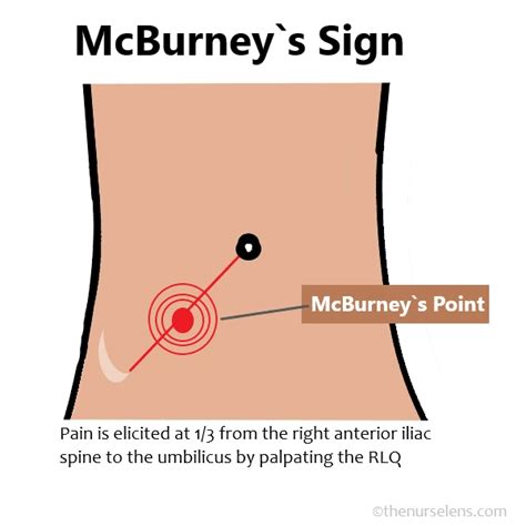 Appendicitis Causes Symptoms And Treatment Options