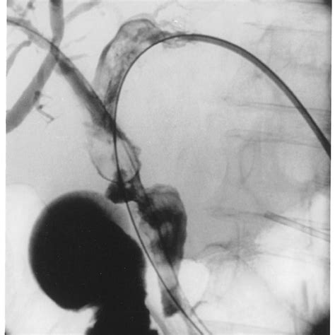 Cholangiogram Performed Through An Indwelling Transhepatic Catheter