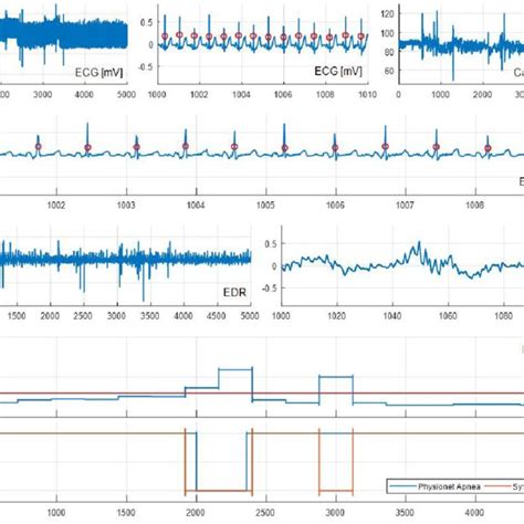Example Of Qrs Detection Red Dots Ecg Derived Respiration Edr Download Scientific Diagram