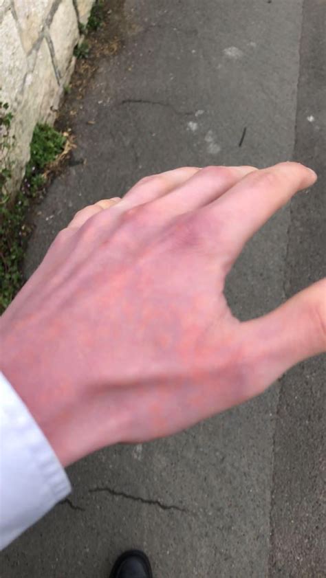 Is This Raynauds Rraynauds Is This Raynauds Rraynauds
