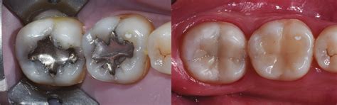 The Old Defective Restorations Were Replaced With Direct Resin Download Scientific Diagram