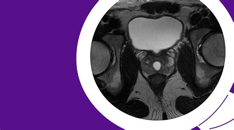 Midline Prostatic Cyst And Infertility Tured Success Story Nyu Langone Health Physician Focus