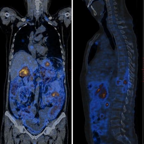Positron Emission Tomography Computed Tomography Of The Whole Body At