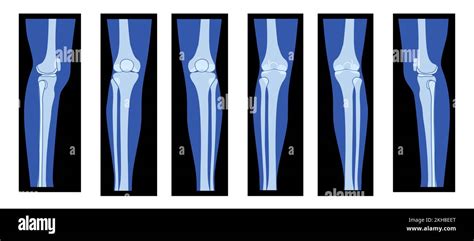 Tibia And Fibula Anatomy Xray