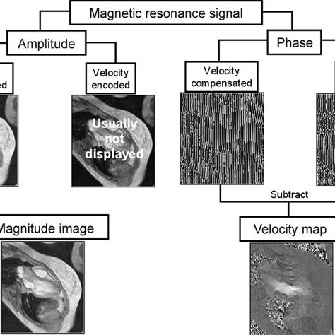 Phenomenon Of Aliasing Through Plane Velocity Mapping Of The Aortic Download Scientific