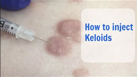 Steroid Injection For Keloid Cost Philippines At Edward Beatty Blog