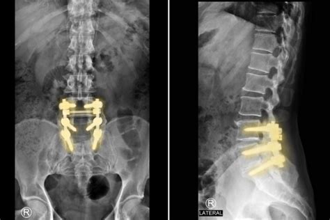 Lumbar Spinal Fusion Dr Swapnil Sanjay Hajare Spine And Orthopedic Surgeon