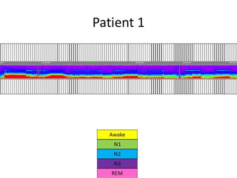 Journal Rudock Et Al Show That Eeg Density Spectral Array Can Be Used To Identify Sleep Stages