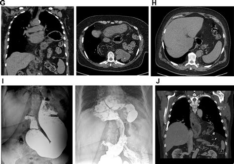 Surgical Anatomy Of Paraesophageal Hernias Thoracic Surgery Clinics
