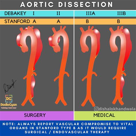 Aortic Dissection Radiology Reference Article