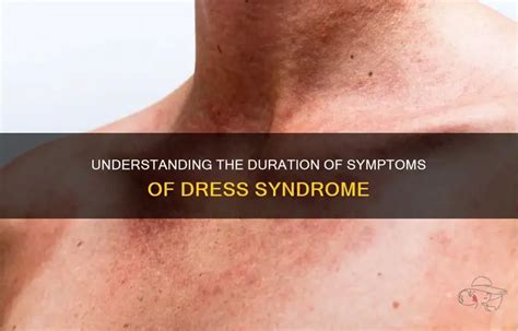 Understanding The Duration Of Symptoms Of Dress Syndrome Shunvogue