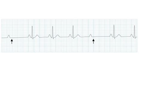 ECG Lecture Sinus Arrest Sinoatrial Exit Block AV Block And Escape Rhythms PPT