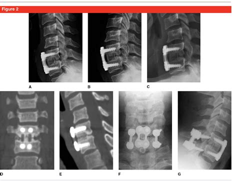 Pseudarthrosis Of The Spine Semantic Scholar