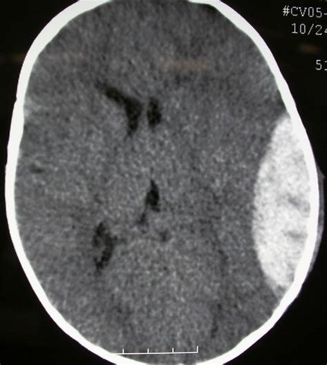 Epidural Hematoma