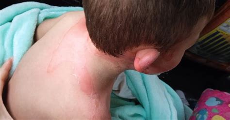 сімя повідомила що їхній дворічний син мав опіки другого ступеня в саду в Боготі Infobae