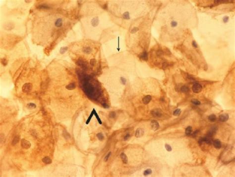 Examples Of Negative And Strong Bak Antibody Staining Intensity Bak