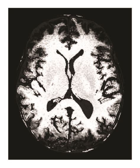 Segmentation On Another Real Medical Image Using The Proposed Method Download Scientific