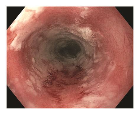 La Grade D Esophagitis Extending To The Middle Esophagus Download