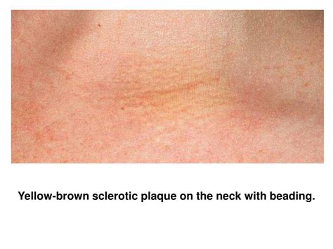Ppt The Face In Diffuse Systemic Sclerosis Note The Radial Furrows Surrounding The Mouth