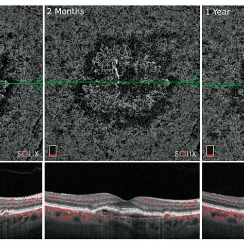 Courtesy Of Scharf Et Al 2020 Choriocapillaris Flow Deficits Around Download Scientific