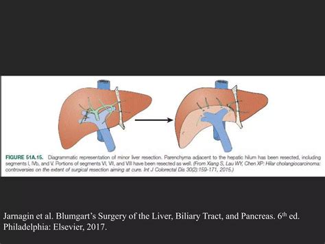 Hilar Cholangiocarcinoma In My Point Of View Pptx