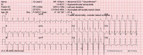 Ekg Rate Chart Ponasa