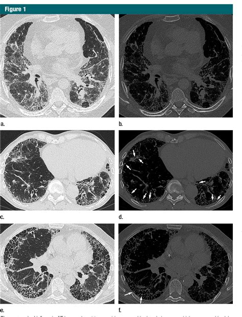 Table 1 From Diffuse Pulmonary Ossification In Fibrosing Interstitial