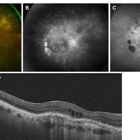 Clinical Imaging Features Of A Patient With A Diagnosis Of Pvrl And