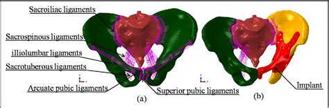 Figure 1 From Development Of Finite Element Model For Customized Prostheses Design For Patient