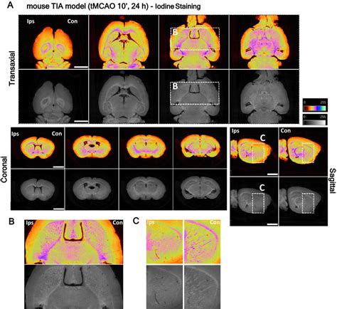 Identification Of Striatum White Fiber Degeneration In Transient