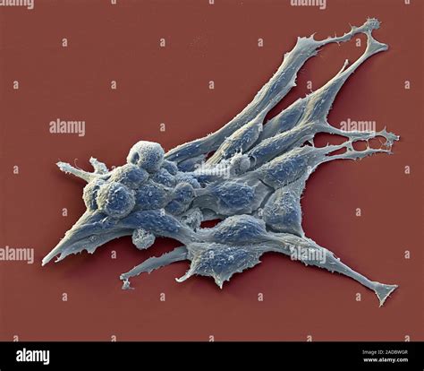 Prostate Cancer Cells Coloured Scanning Electron Micrograph Sem The Uneven Surface Of These