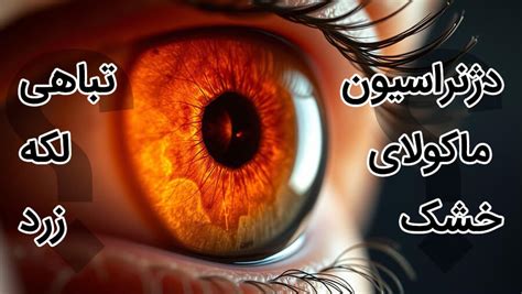 تباهی لکه زرد یا دژنراسیون ماکولای خشک چیست؟ علت و درمان مجله آرکوشاپ