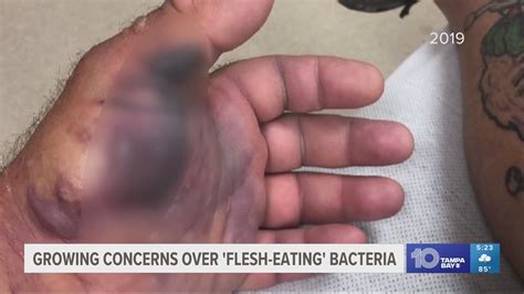 Flesh Eating Disease Causes