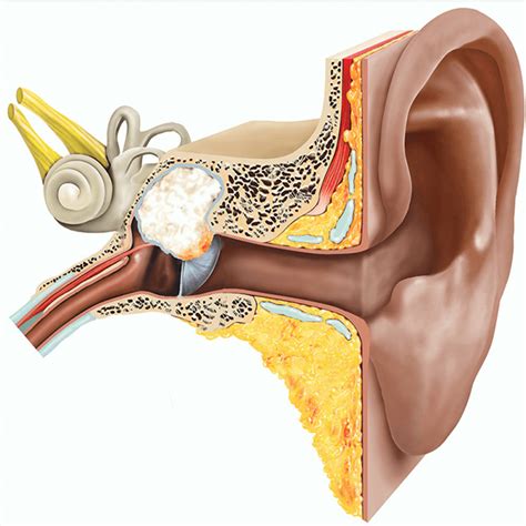 What Happens If Surgery Is Not Done For Unsafe Csom Or Cholesteatoma
