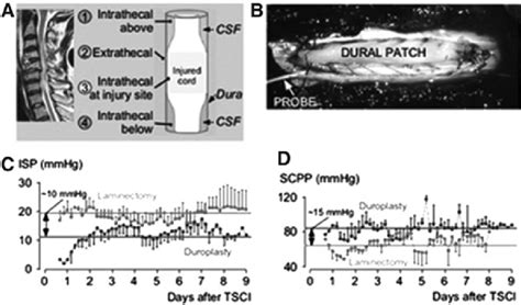Proposed Expansion Duraplasty Aimed At Reducing Intraspinal Pressure