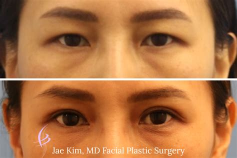 Asian Eyelid Surgery Jae Kim Md