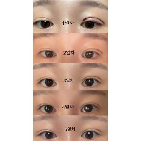 쌍수 재수술 후기 한쪽 눈만 재수술한 사람 나야나 네이버 블로그