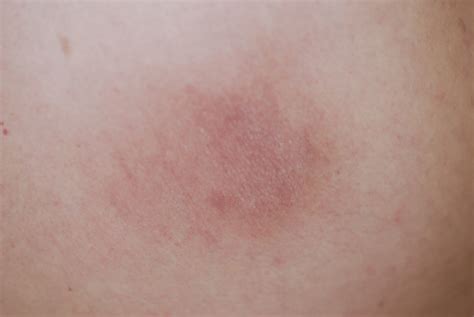 Small Area Of Hyperpigmentation Over The Patients Back Download