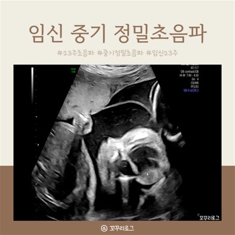 임신 23주 중기 정밀 초음파 비용 얼굴 콧대 심장 자궁경부 길이 네이버 블로그