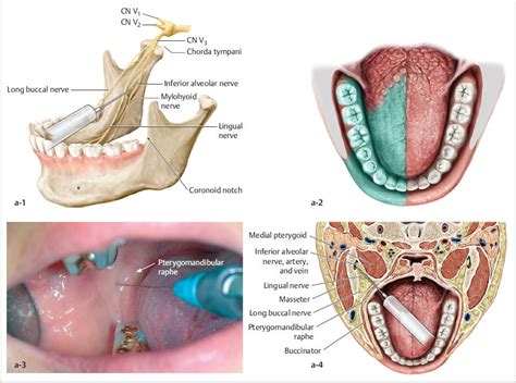 Coronoid Notch