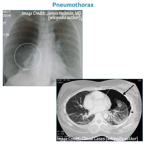 Clinical Pathology Glossary Pneumothorax Ditki Medical And Biological