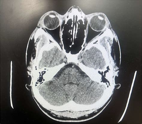 Axial View Of Ct Brain Without Contrast Showing No Abnormal Findings