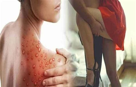 बड खबर अनसफ सकस क वजह स दलल म फल Monkeypox अधययन म चकन वल खलस