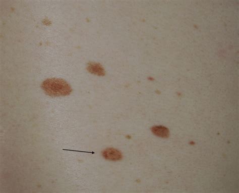 Balloon Cell Nevus Histologic And Dermoscopic Features Journal Of