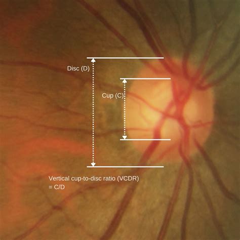 An Illustration Of The Optic Nerve Head Onh And The Vertical Download Scientific Diagram