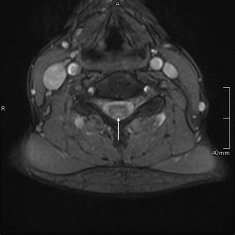 Axial T2wi Of The Cervical Spinal Cord With A Bilateral T2